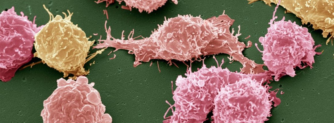 Osimertinib With Or Without Chemotherapy In Egfr Mutated Advanced Nsclc Hopa